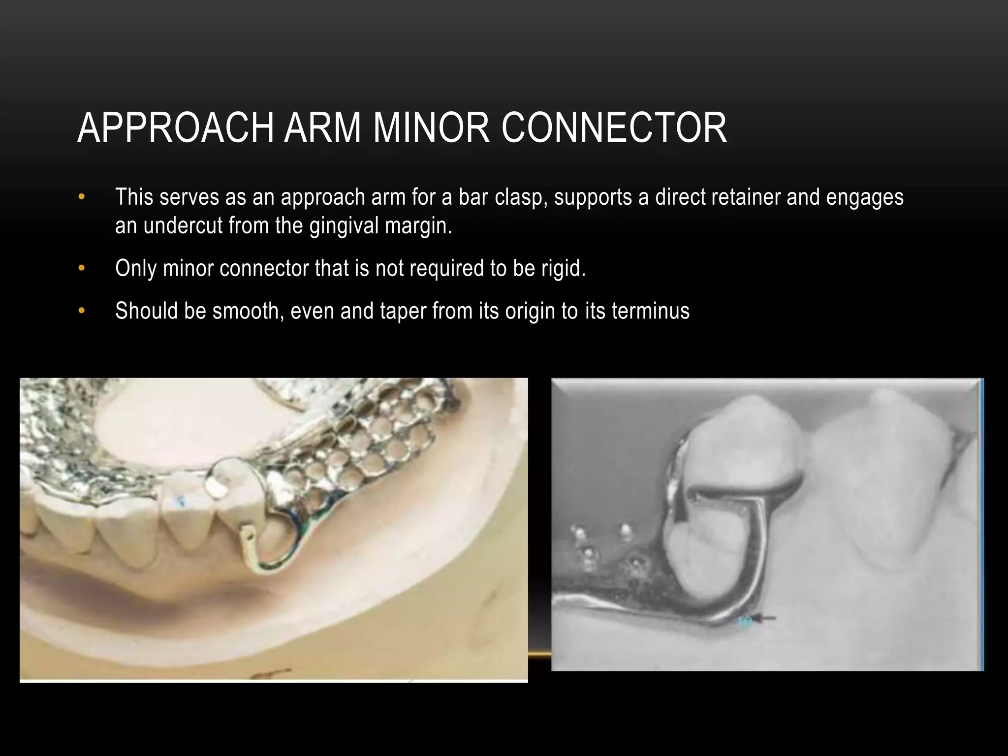MAJOR CONNECTORS AND MINOR CONNECTORS IN RPD - Dr Prathibha Prasad | PPTX