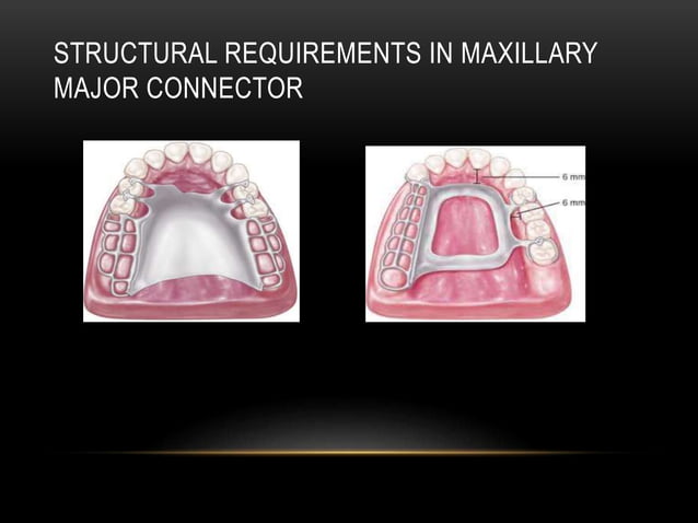 MAJOR CONNECTORS AND MINOR CONNECTORS IN RPD - Dr Prathibha Prasad ...