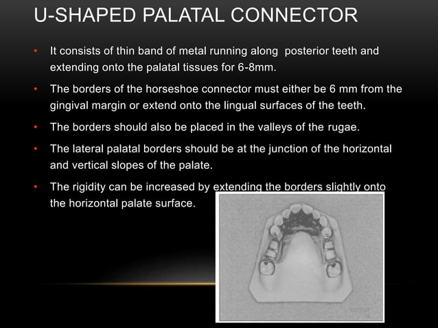 MAJOR CONNECTORS AND MINOR CONNECTORS IN RPD - Dr Prathibha Prasad ...