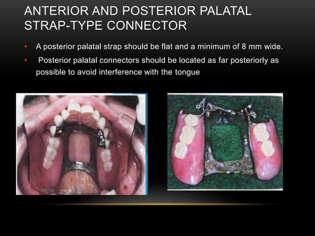 MAJOR CONNECTORS AND MINOR CONNECTORS IN RPD - Dr Prathibha Prasad ...