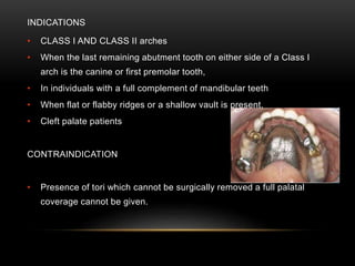 MAJOR CONNECTORS AND MINOR CONNECTORS IN RPD - Dr Prathibha Prasad | PPTX