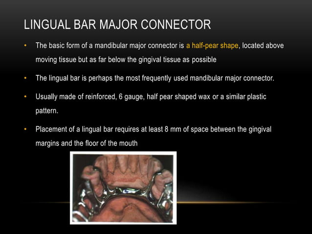 MAJOR CONNECTORS AND MINOR CONNECTORS IN RPD - Dr Prathibha Prasad ...
