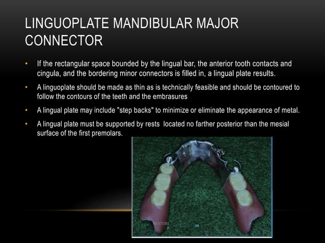 MAJOR CONNECTORS AND MINOR CONNECTORS IN RPD - Dr Prathibha Prasad ...
