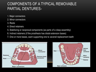 MAJOR CONNECTORS AND MINOR CONNECTORS IN RPD - Dr Prathibha Prasad | PPTX