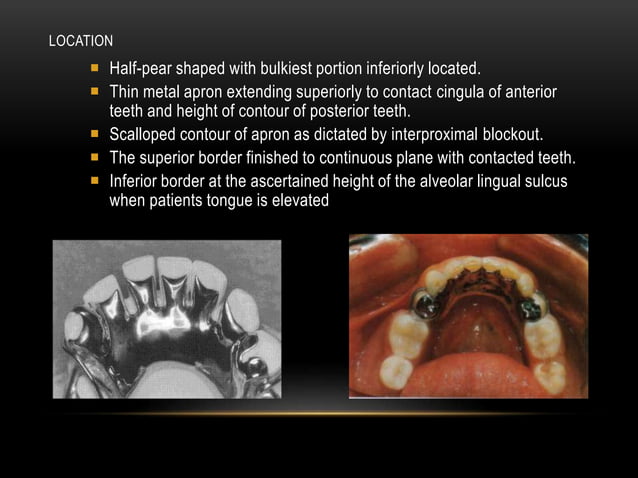 MAJOR CONNECTORS AND MINOR CONNECTORS IN RPD - Dr Prathibha Prasad ...
