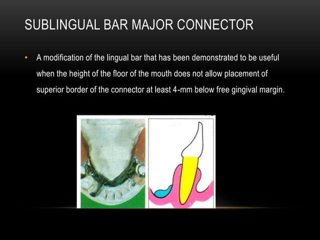 MAJOR CONNECTORS AND MINOR CONNECTORS IN RPD - Dr Prathibha Prasad ...