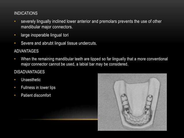 MAJOR CONNECTORS AND MINOR CONNECTORS IN RPD - Dr Prathibha Prasad ...