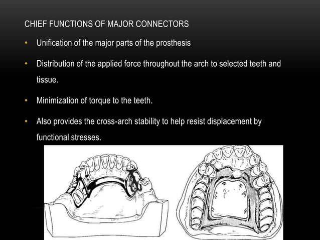 MAJOR CONNECTORS AND MINOR CONNECTORS IN RPD - Dr Prathibha Prasad ...