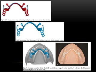MAJOR CONNECTORS AND MINOR CONNECTORS IN RPD - Dr Prathibha Prasad | PPTX