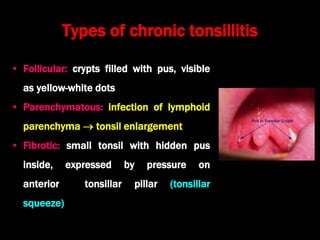 3.tonsils and adenoids | PPT