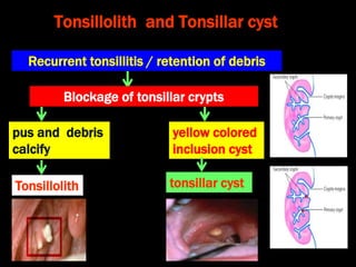 3.tonsils and adenoids | PPT