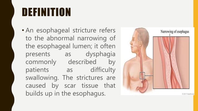 DISORDERS OF ESOPHAGUS | PPTX | Digestive Disorders | Diseases and ...