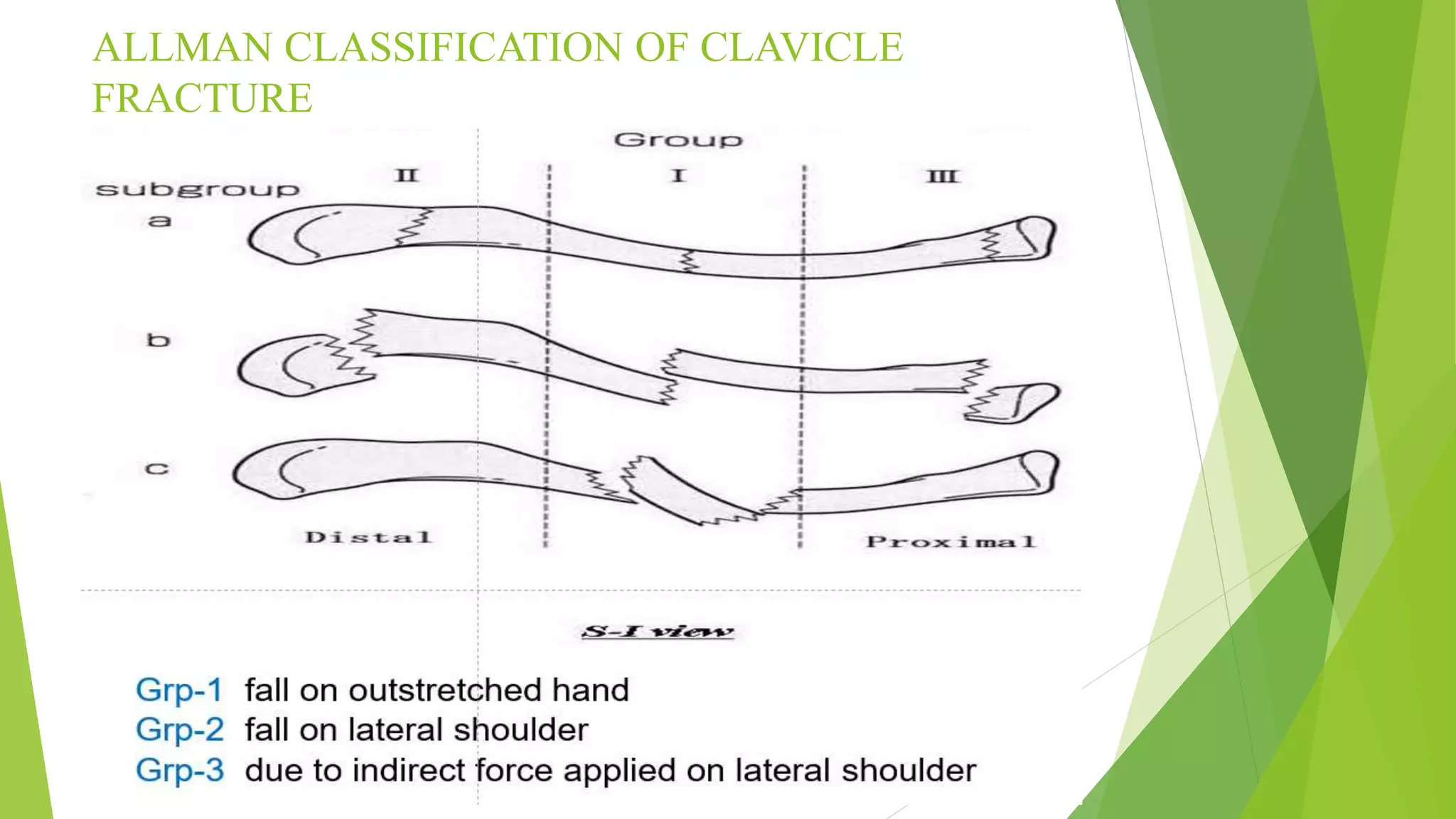 Clavicle fracture and its management | PPTX