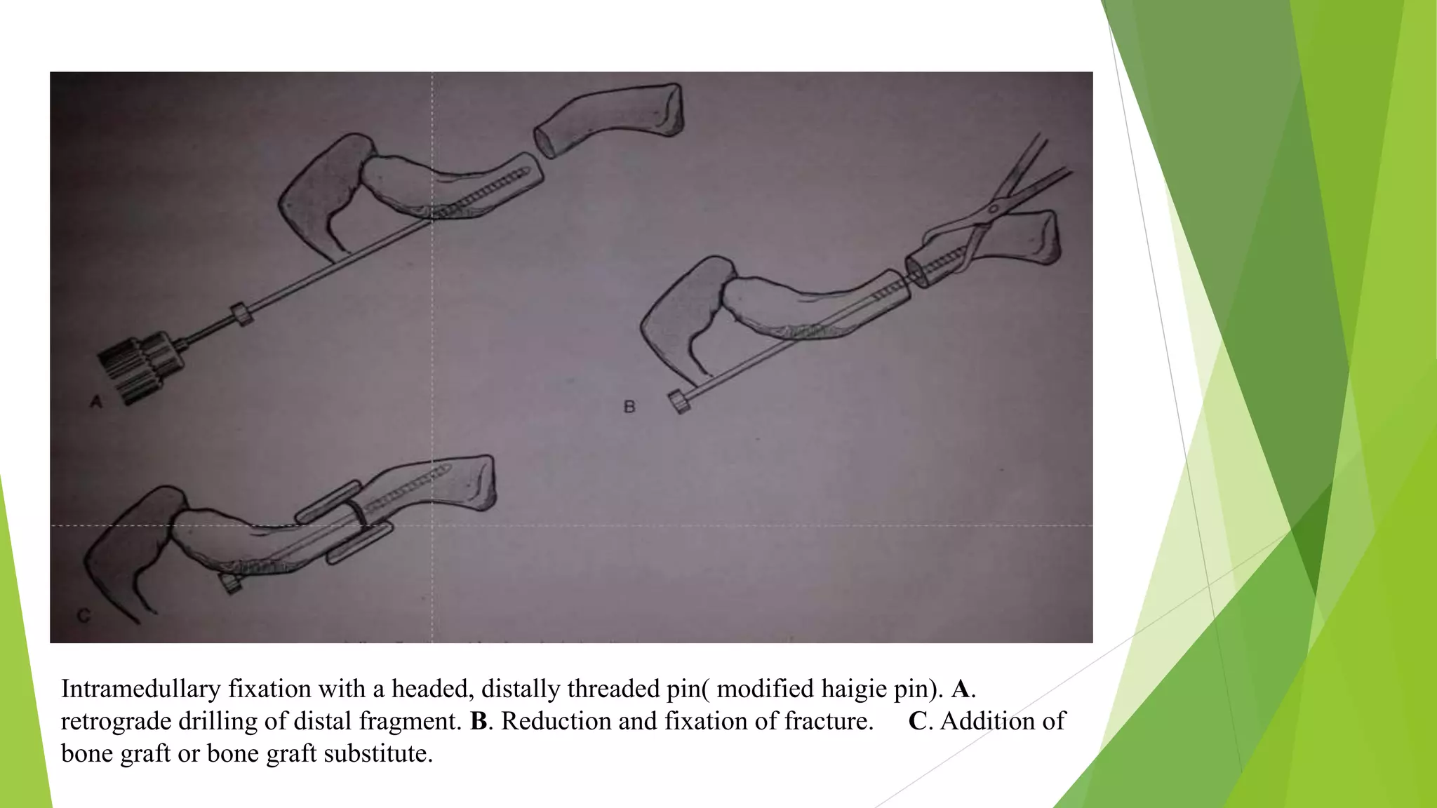Clavicle fracture and its management | PPTX