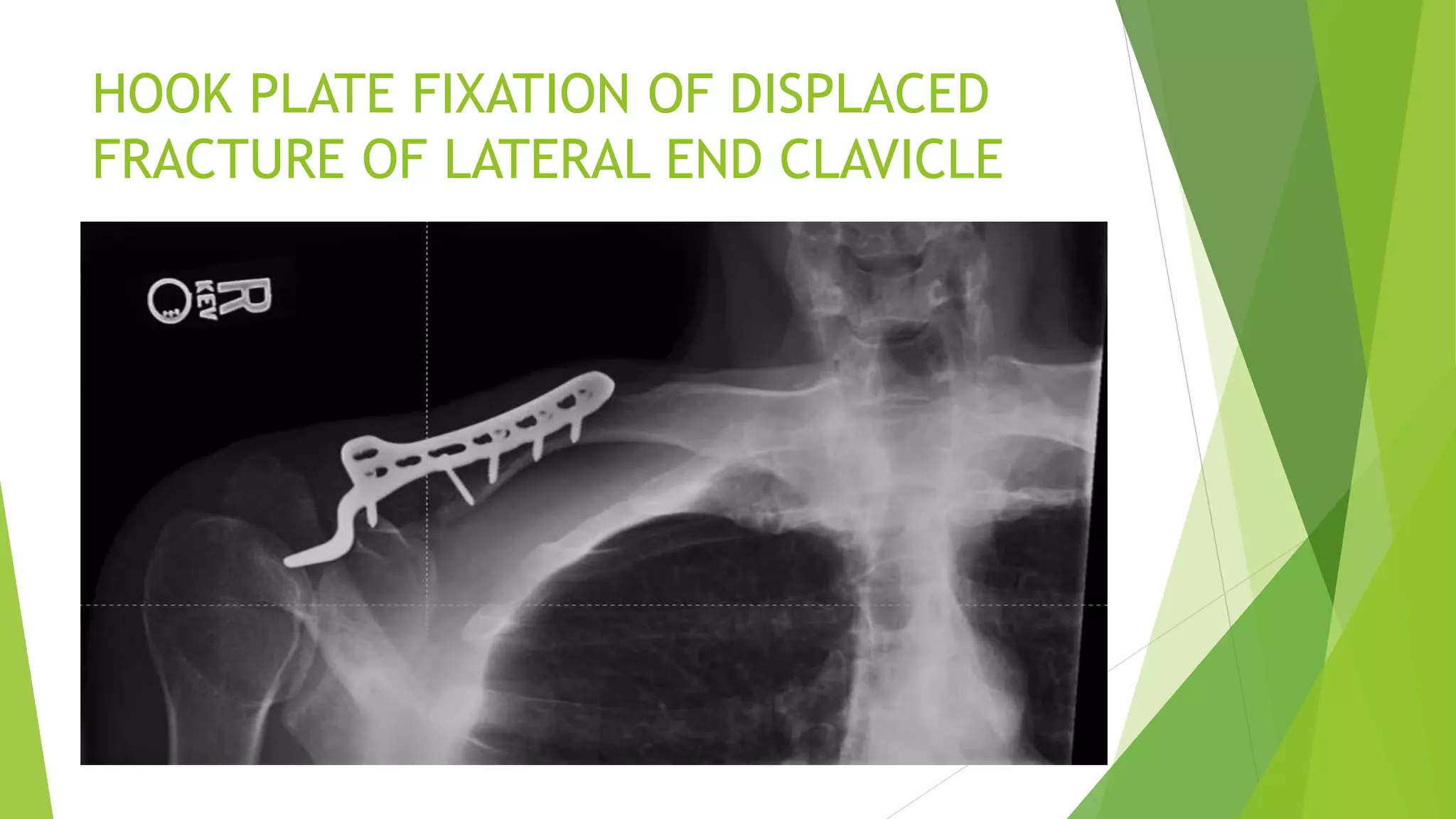 Clavicle fracture and its management | PPTX