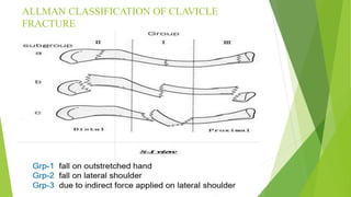 Clavicle fracture and its management | PPTX