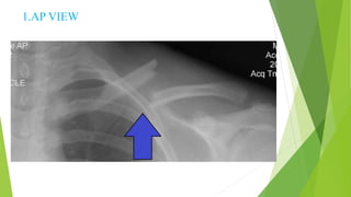 Clavicle fracture and its management | PPTX