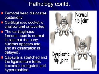 Developmental Dysplasia Of Hip | PPT
