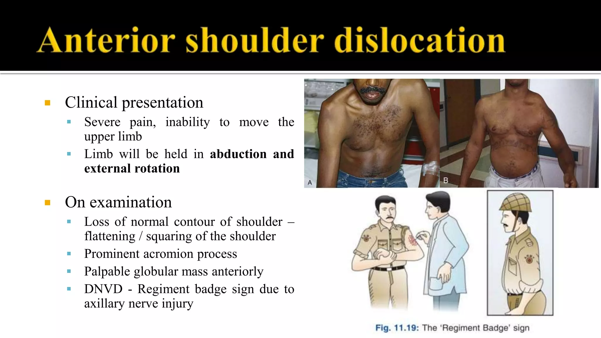 Shoulder dislocation | PPTX