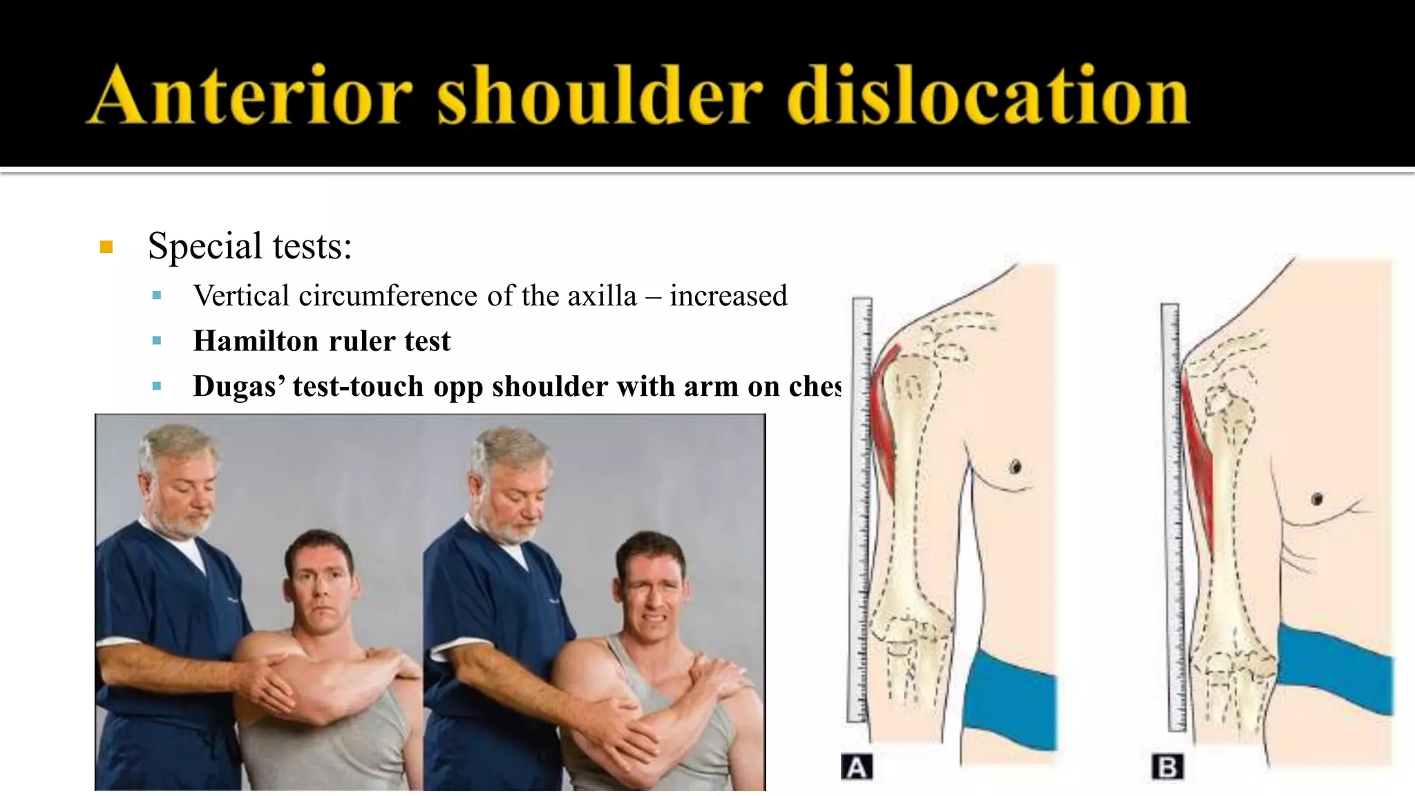 Shoulder dislocation | PPTX