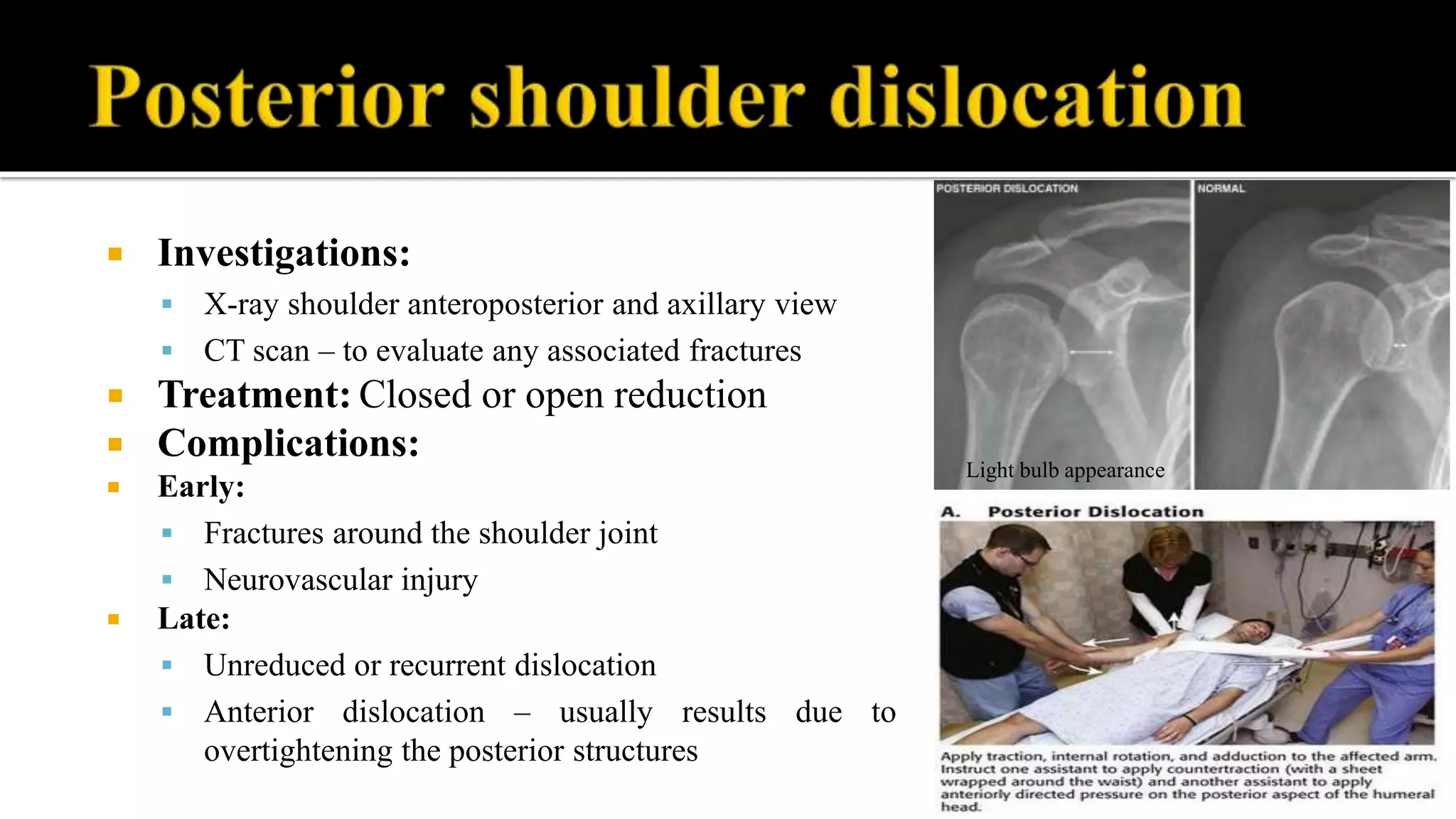Shoulder dislocation | PPTX