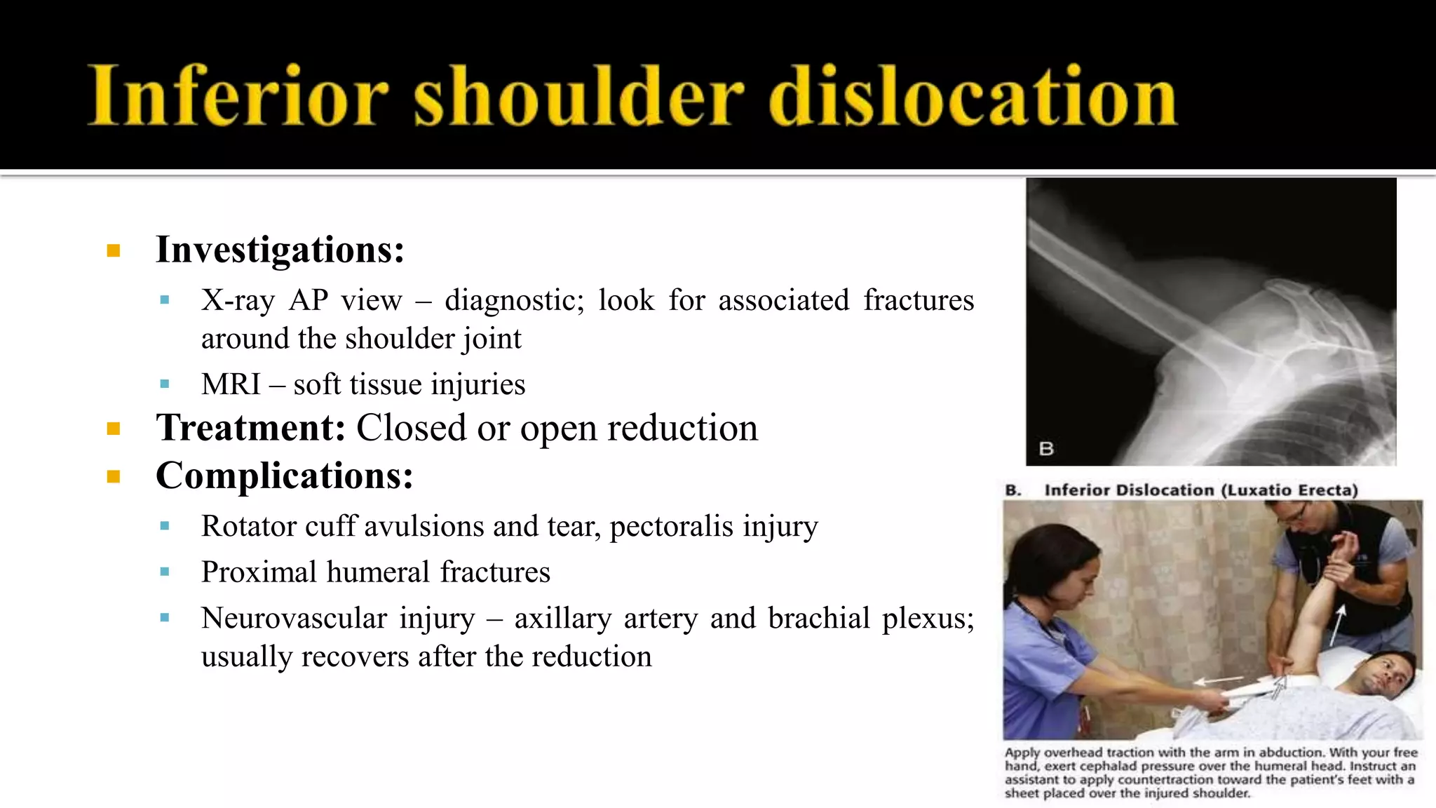 Shoulder dislocation | PPTX
