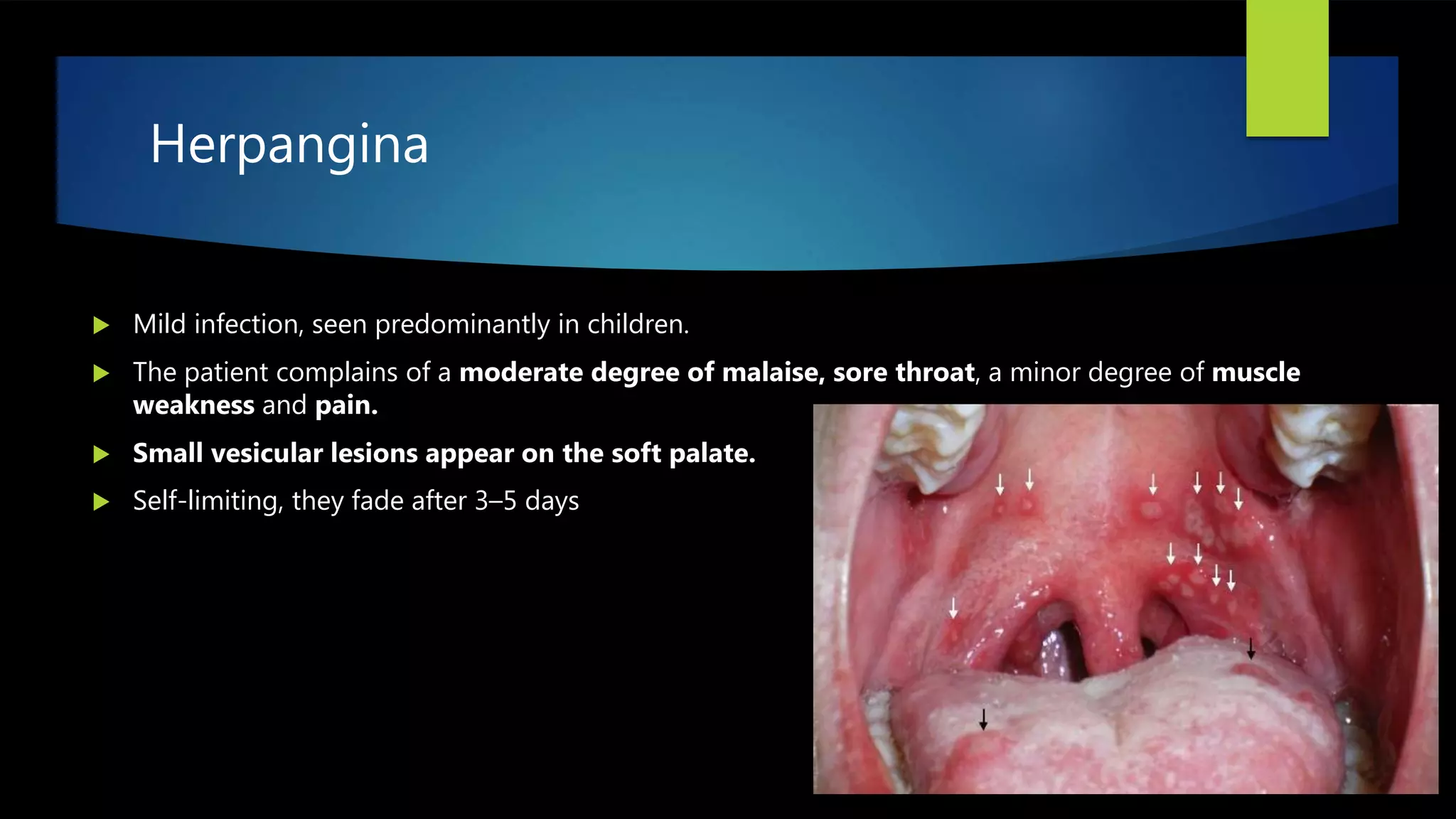 Viral Infections of Oral Mucosa | PPTX
