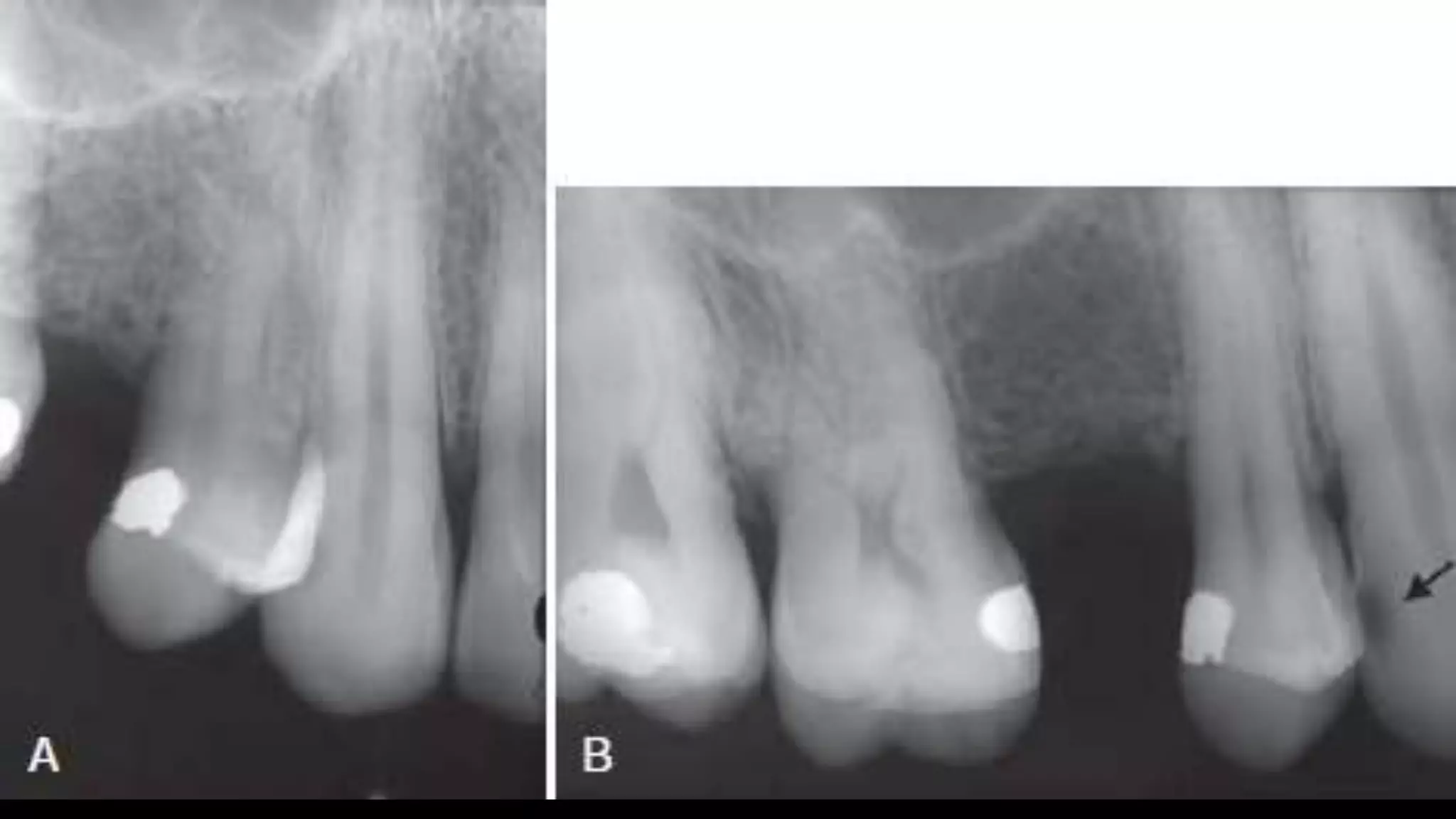 Radiographic Interpretation of Dental Caries | PPTX