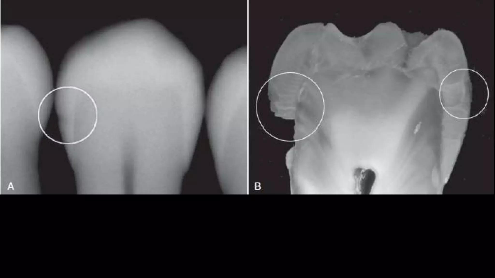 Radiographic Interpretation of Dental Caries | PPTX