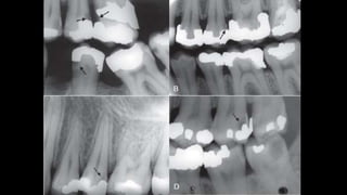 Radiographic Interpretation of Dental Caries | PPTX