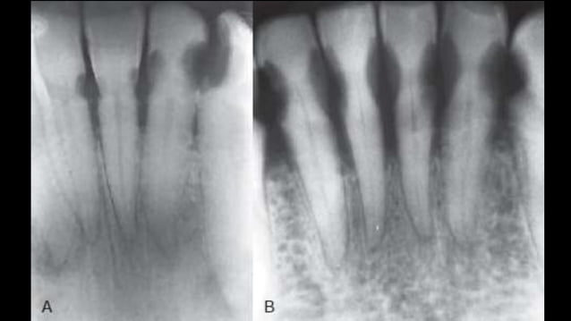 Radiographic Interpretation of Dental Caries | PPTX