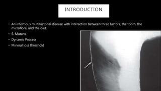 Radiographic Interpretation of Dental Caries | PPTX