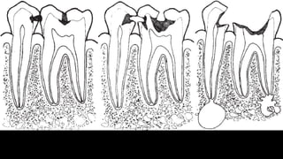 Radiographic Interpretation of Dental Caries | PPTX