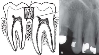 Radiographic Interpretation of Dental Caries | PPTX