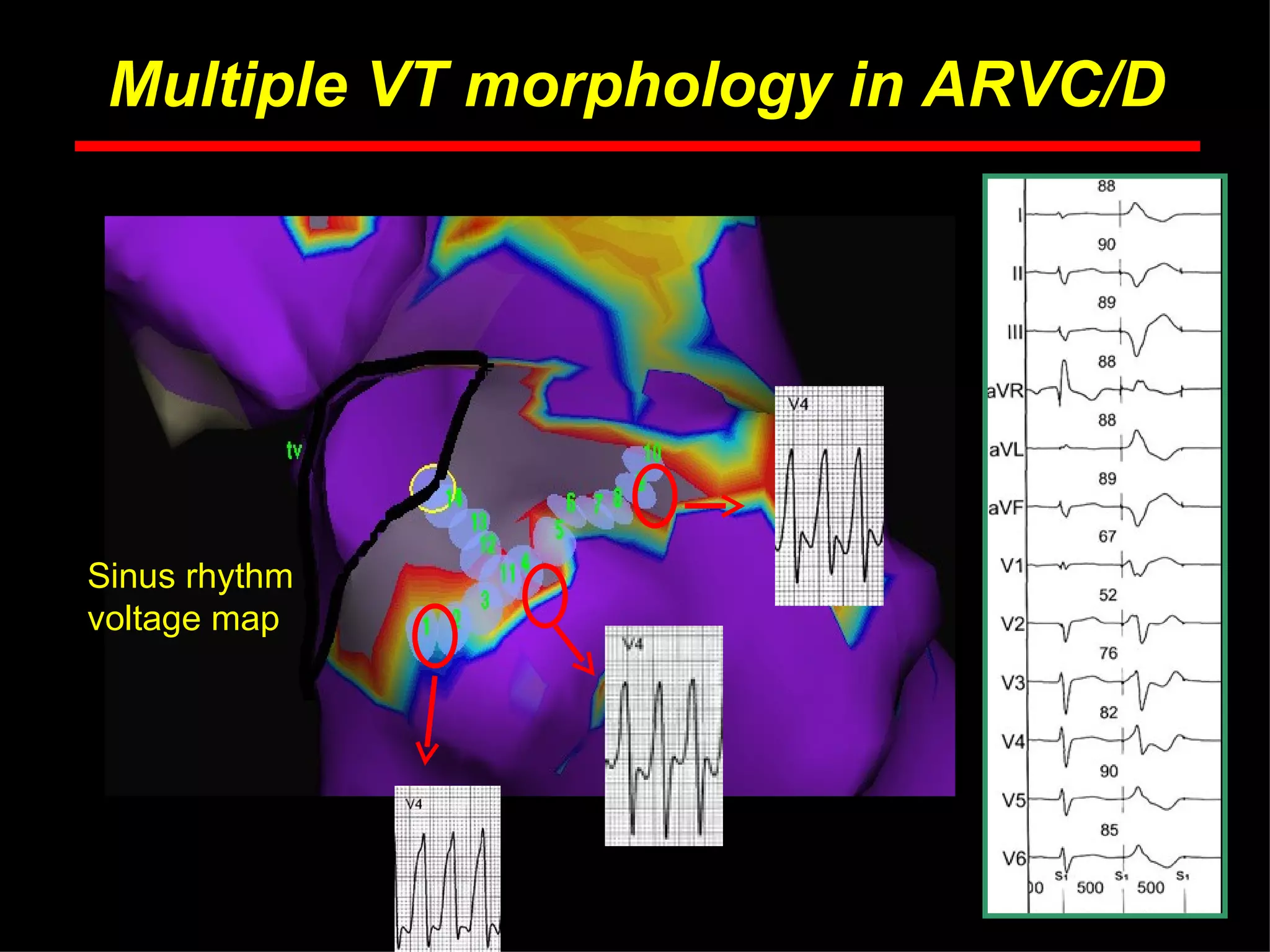 Catheter ablation of ventricular tachycardia | PPT