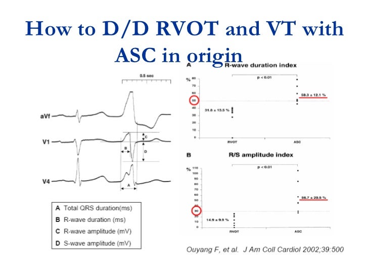 Catheter ablation of ventricular tachycardia