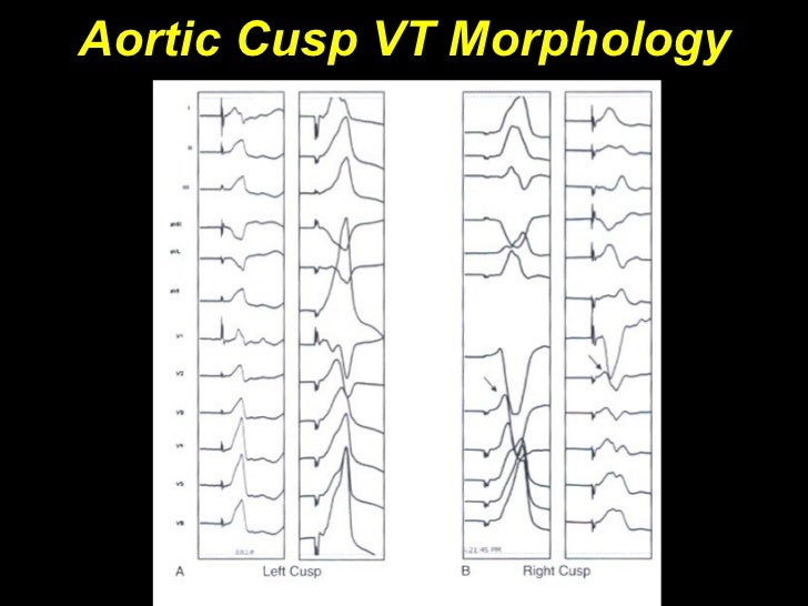 Catheter ablation of ventricular tachycardia