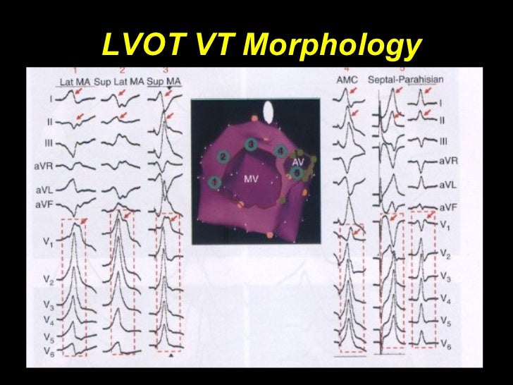 Catheter ablation of ventricular tachycardia