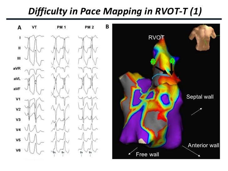 Catheter ablation of ventricular tachycardia
