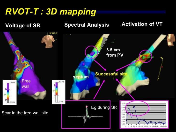 Catheter ablation of ventricular tachycardia