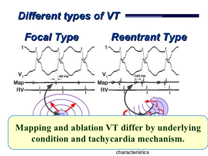 Catheter ablation of ventricular tachycardia