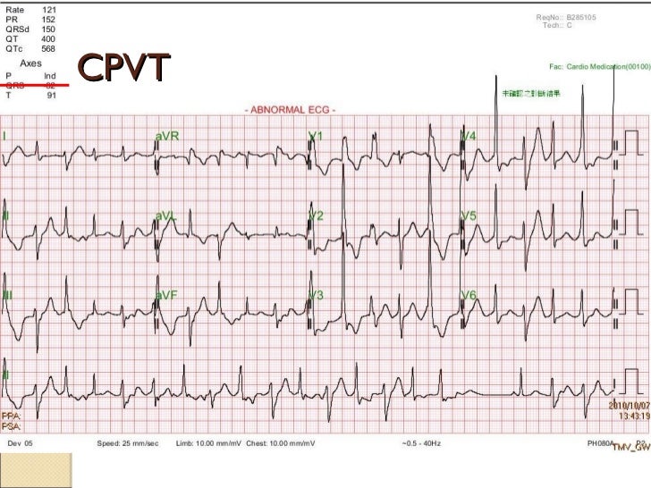 Catheter ablation of ventricular tachycardia