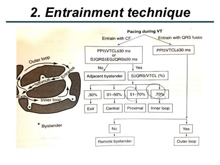 Catheter ablation of ventricular tachycardia