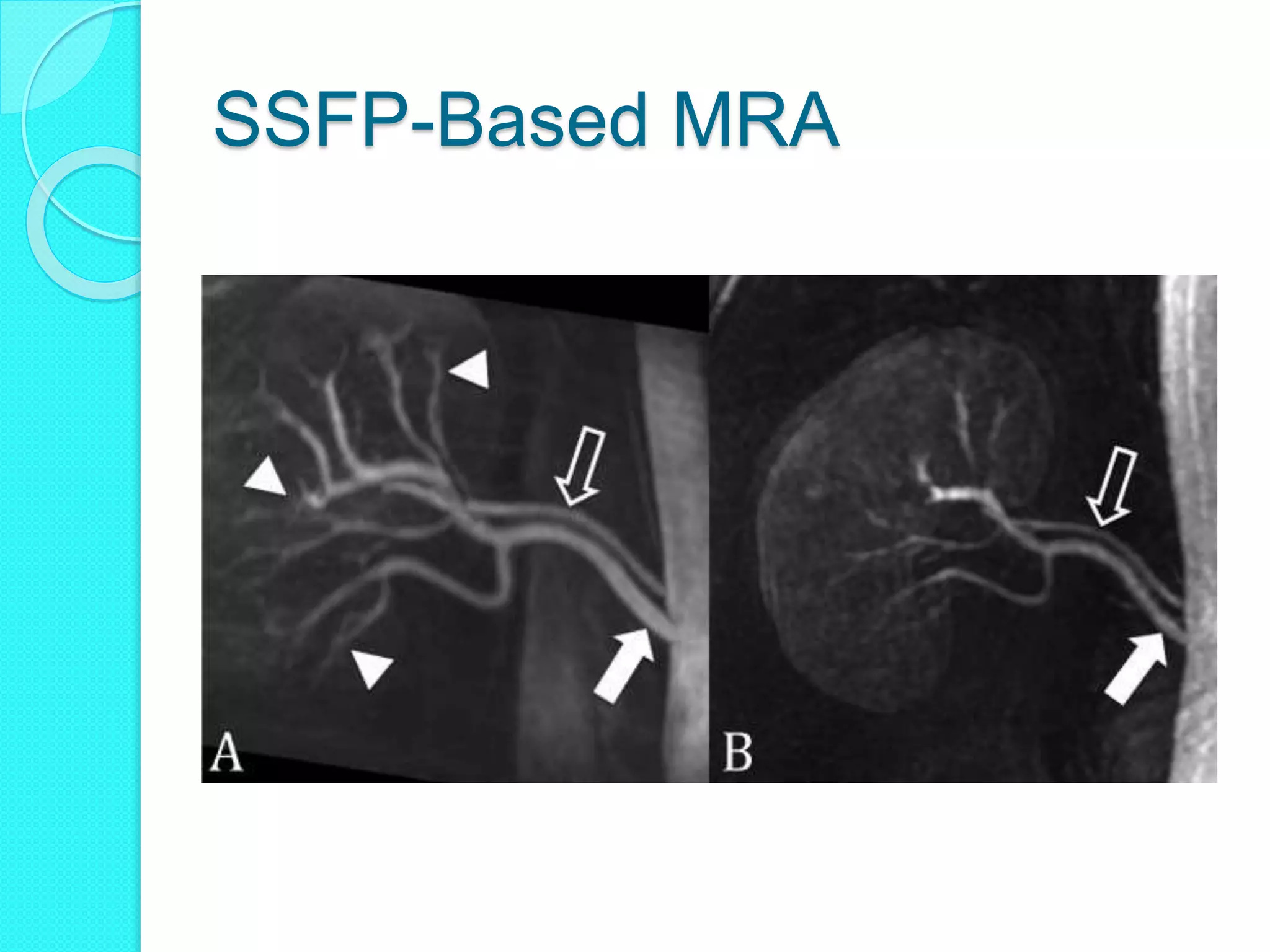 Steady State Free Precession MRA | PPTX