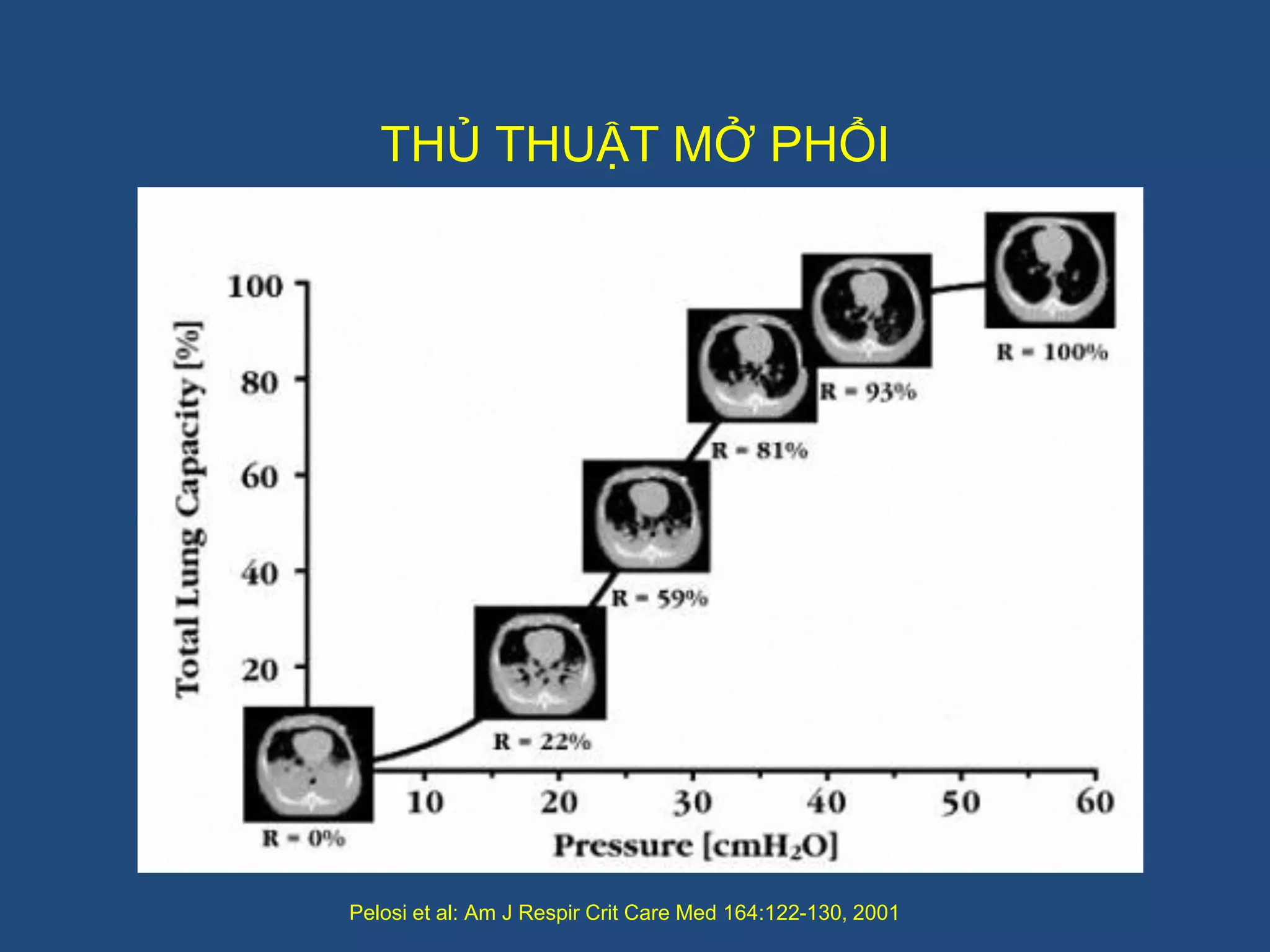 HỘI CHỨNG SUY HÔ HẤP CẤP NGUY KỊCH | PDF