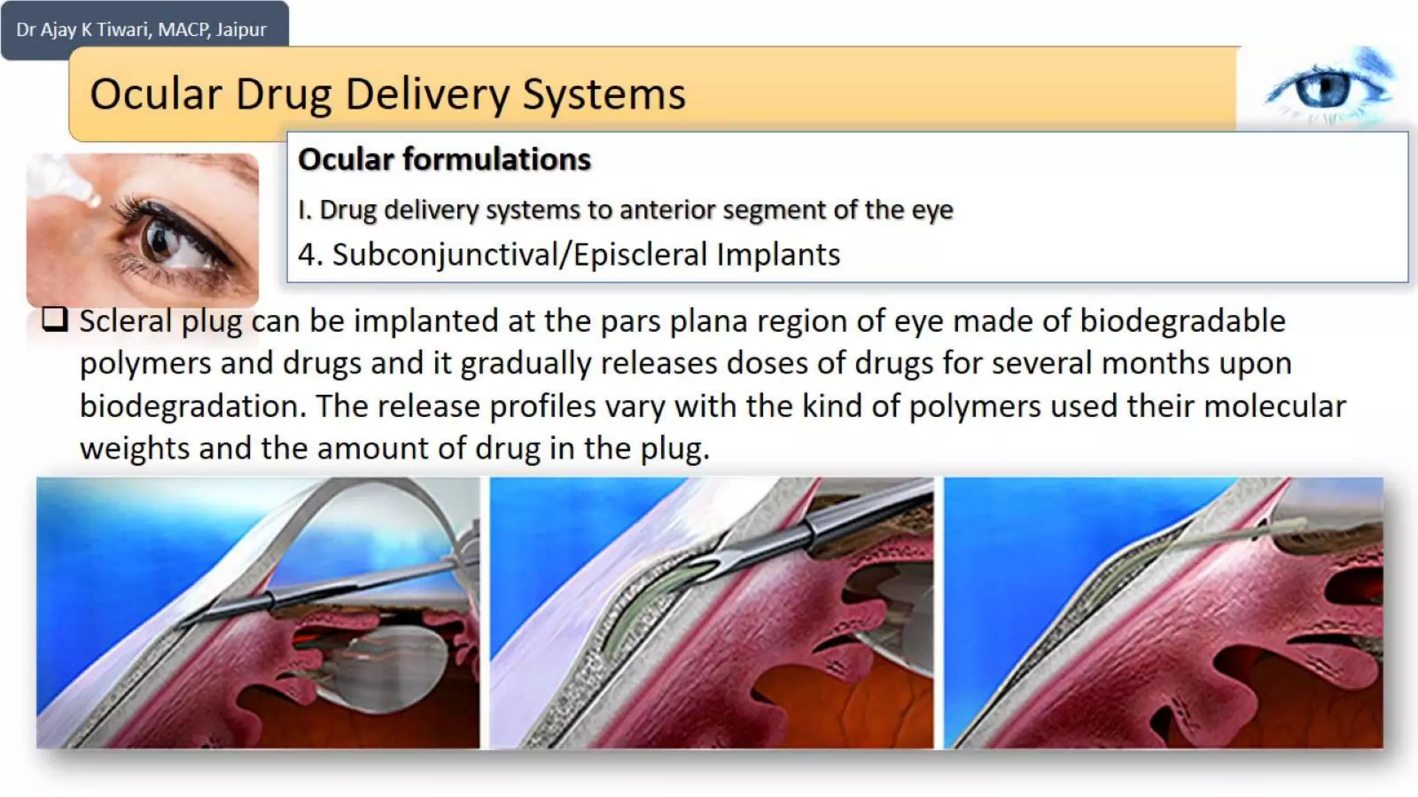 Ocular drug delivery systems (part-3)- Ocular formulations | PPTX | Eye ...