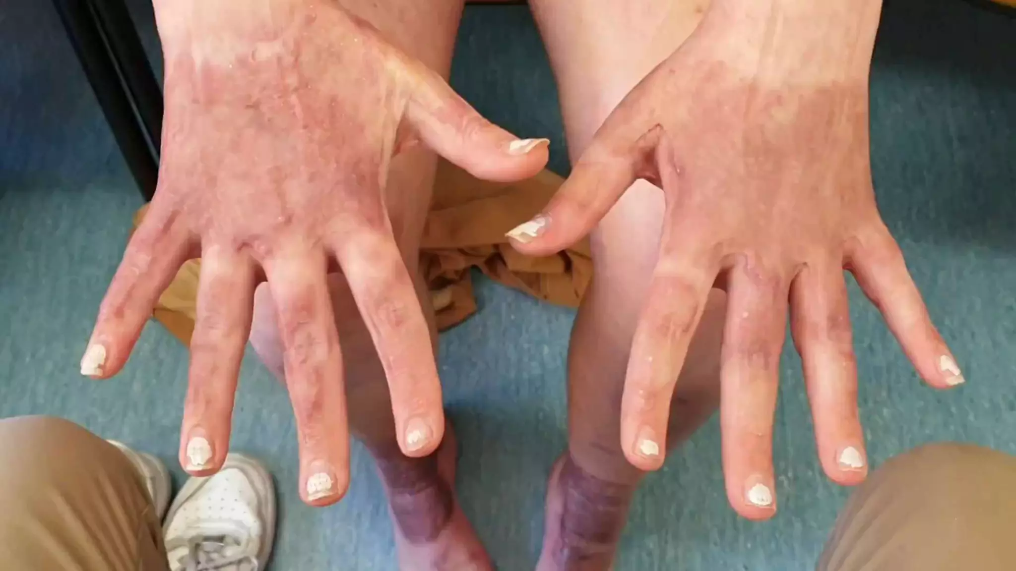 Surgical management of burn injuries | PPTX