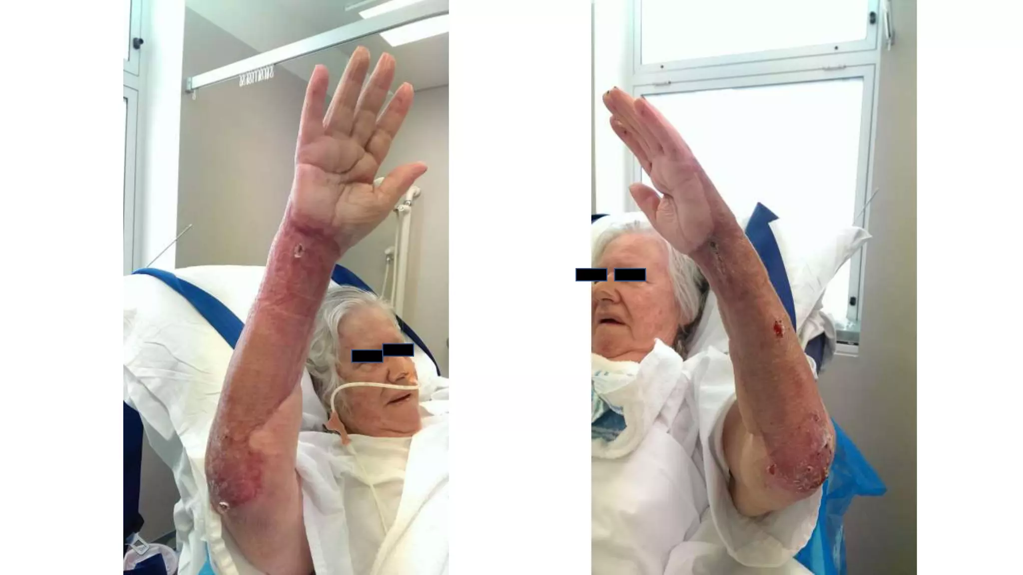 Surgical management of burn injuries | PPTX