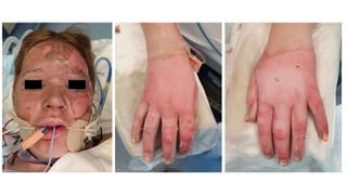 Surgical management of burn injuries | PPTX