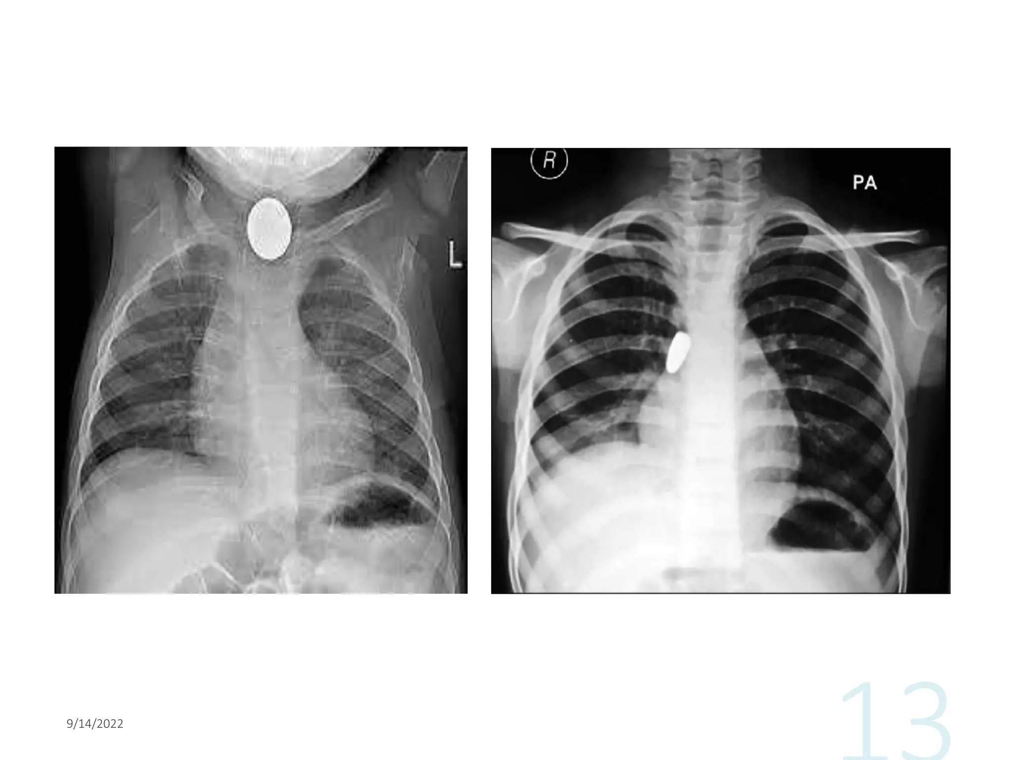 Airway obstruction | PPTX